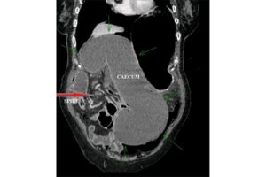 Urgent et rare : le volvulus du caecum - CIMOP
