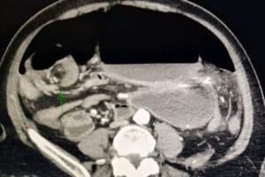 Urgent et rare : le volvulus du caecum - CIMOP